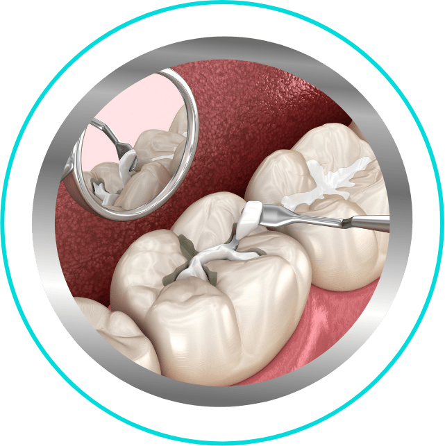 Obturación Rellenos Dentales - Dental COP - El Salvador