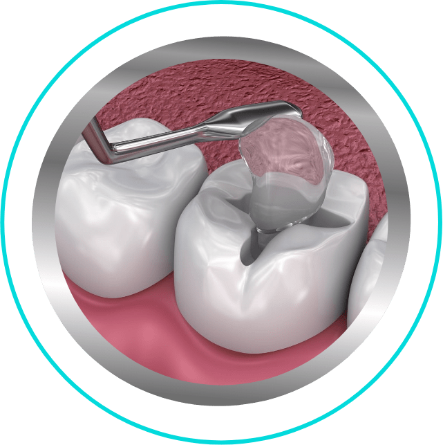Obturación Rellenos Dentales - Dental COP - El Salvador