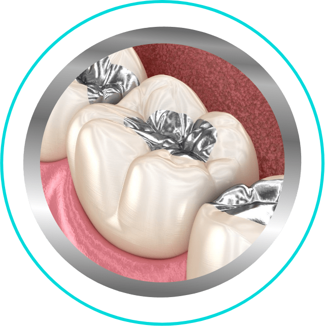 Obturación Rellenos Dentales - Dental COP - El Salvador